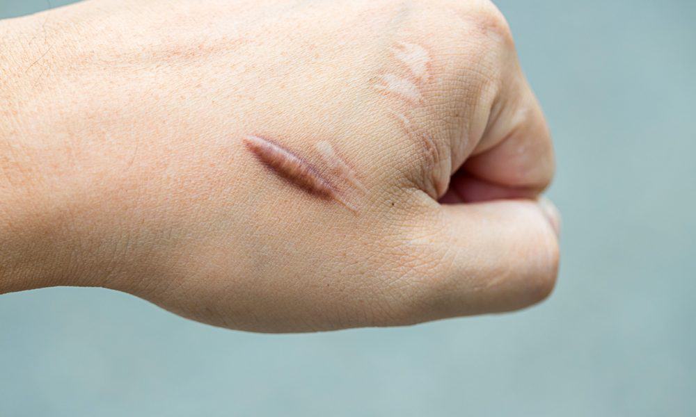 Scars From Cutting Yourself Quotes Scars From Cutting Yourself Quotes